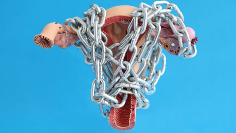 Uterine Fibroids - St. Michael's Elite Hospital